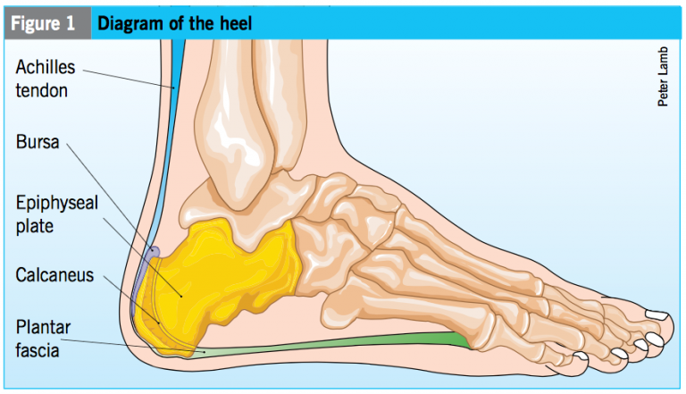 Diagnosis: Sever’s Disease | POGO Physio Gold Coast