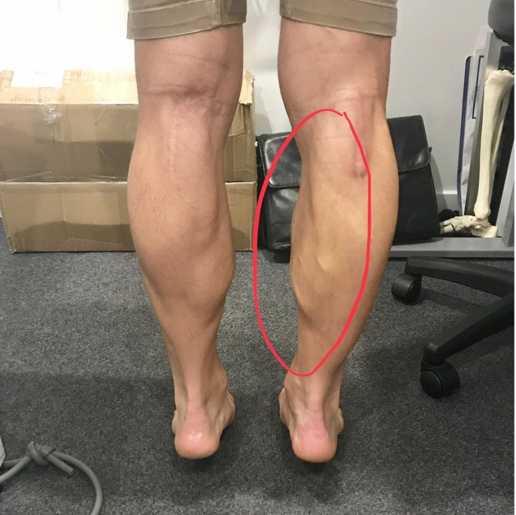 How To Rehab Calf Strains In Runners POGO Physio Gold Coast how-to-rehab-calf-strains-in-runners-pogo-physio-gold-coast