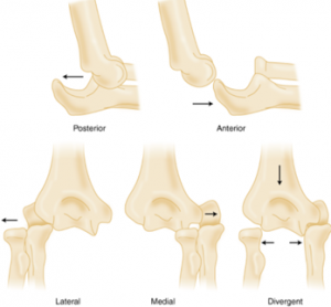 Management of Simple Elbow Dislocations | POGO Physio Gold Coast