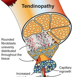 How to Rehabilitate a Tendinopathy: Phase 1 (Reducing symptoms & pain ...