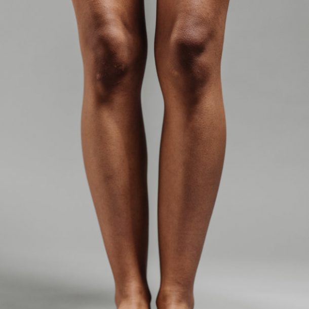 Management of Patellar Dislocations | POGO Physio Gold Coast