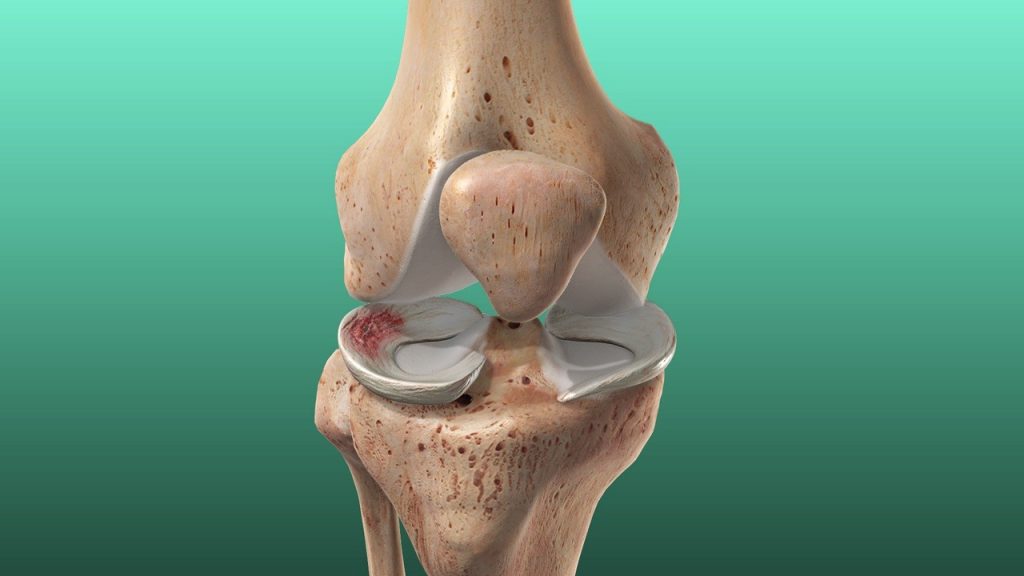 Meniscus Tear: Do I need surgery? | POGO Physio Gold Coast