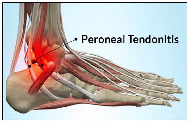 Diagnosis: Peroneal Tendinopathy | POGO Physio Gold Coast