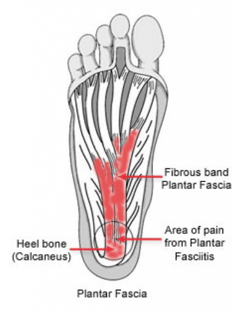 How to Treat Plantar Fasciitis | POGO Physio Gold Coast