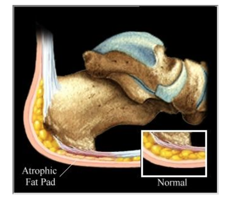 How to Treat Plantar Fasciitis