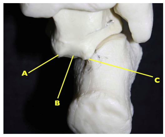 Posterior Ankle Impingement-Pathoanatomy, Assessment and Management ...