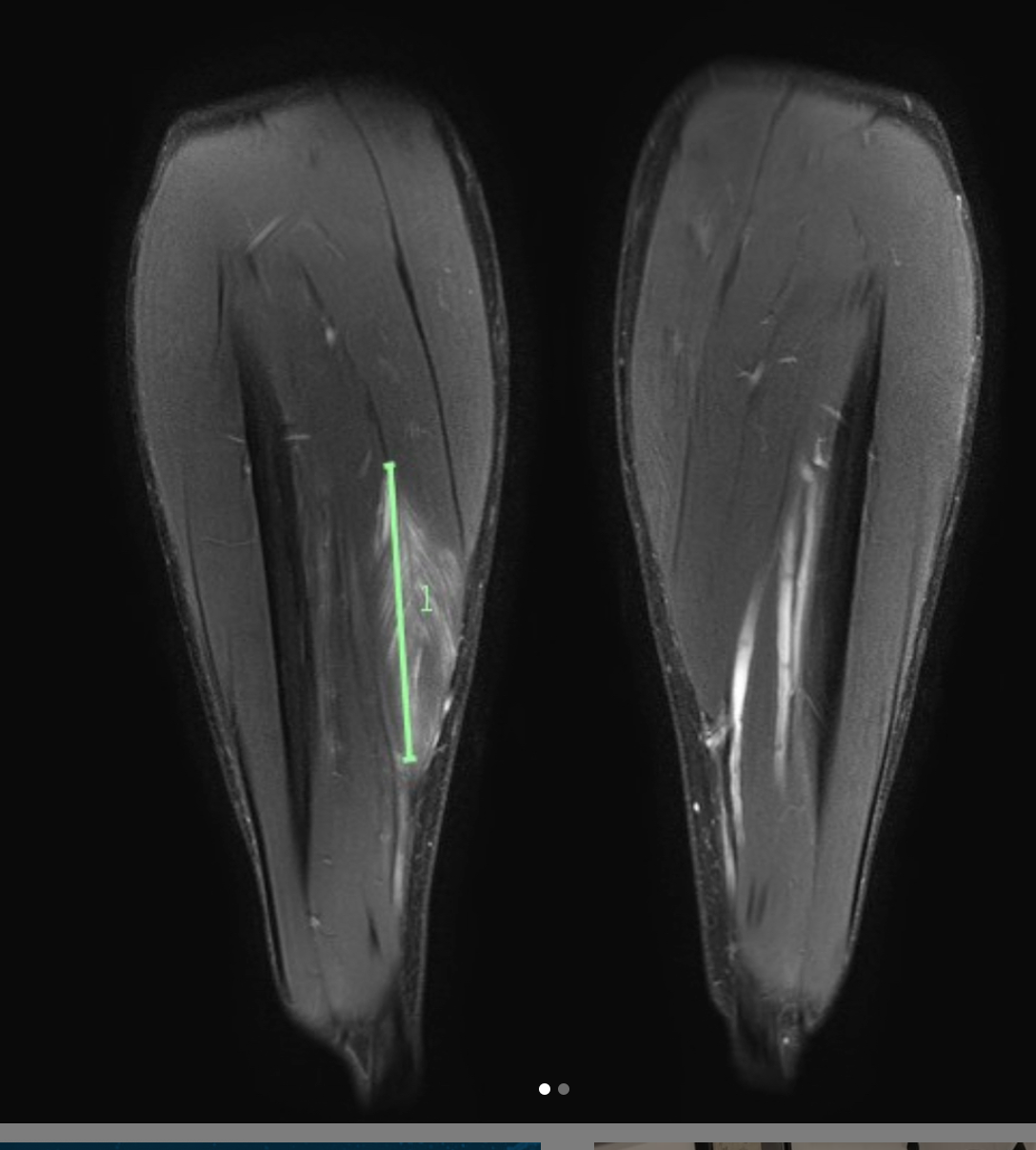 How to rehab calf strains in runners | POGO Physio Gold Coast